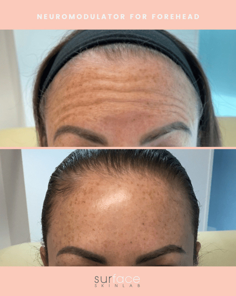 Neurotoxins (Dysport, Xeomin, Nuceiva) – Surface Skin Lab